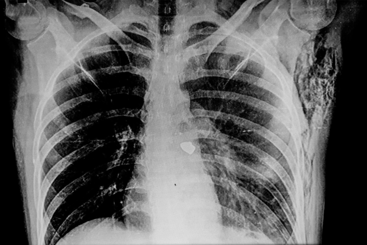 Subcutaneous Emphysema Causes Symptoms Carda Health